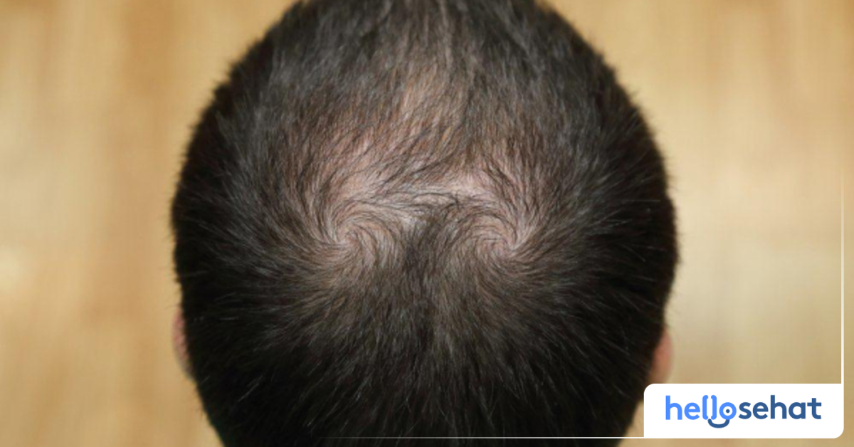 Alopecia (Kebotakan): Gejala, Penyebab, Pengobatan, dll. - Hello Sehat