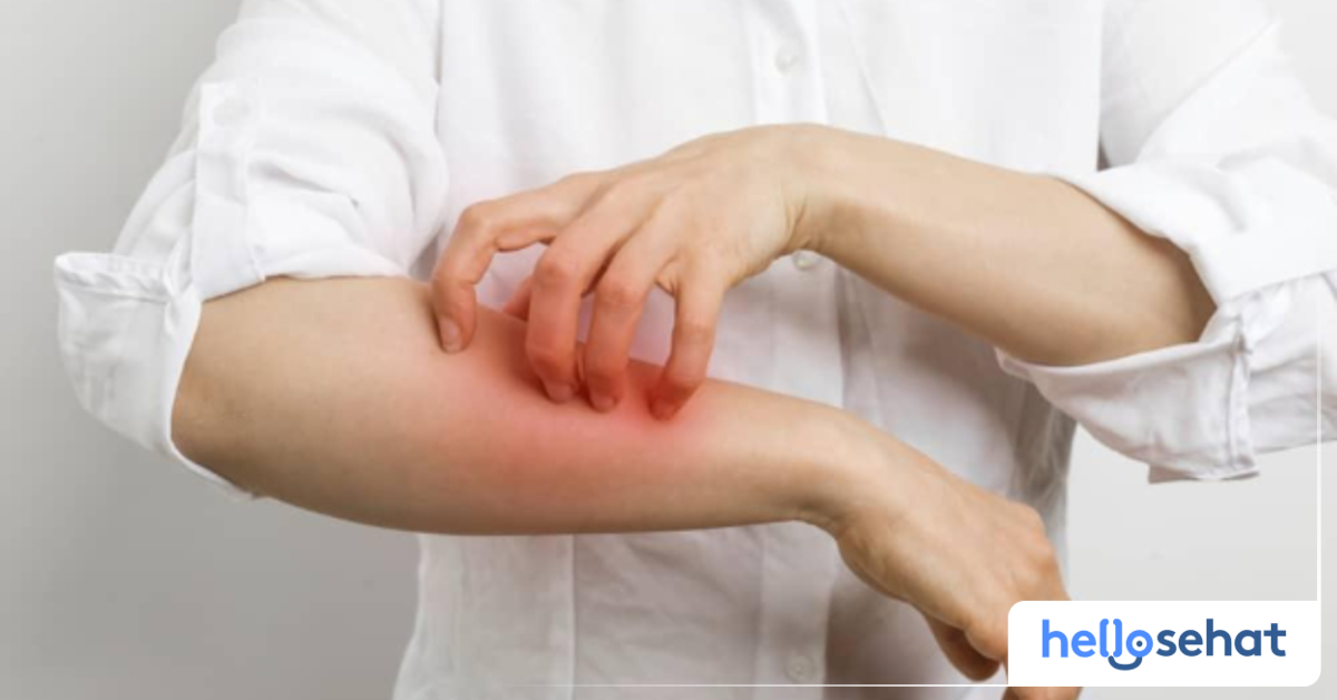 Scabimite: Kegunaan, Dosis, dan Efek Samping - Hello Sehat