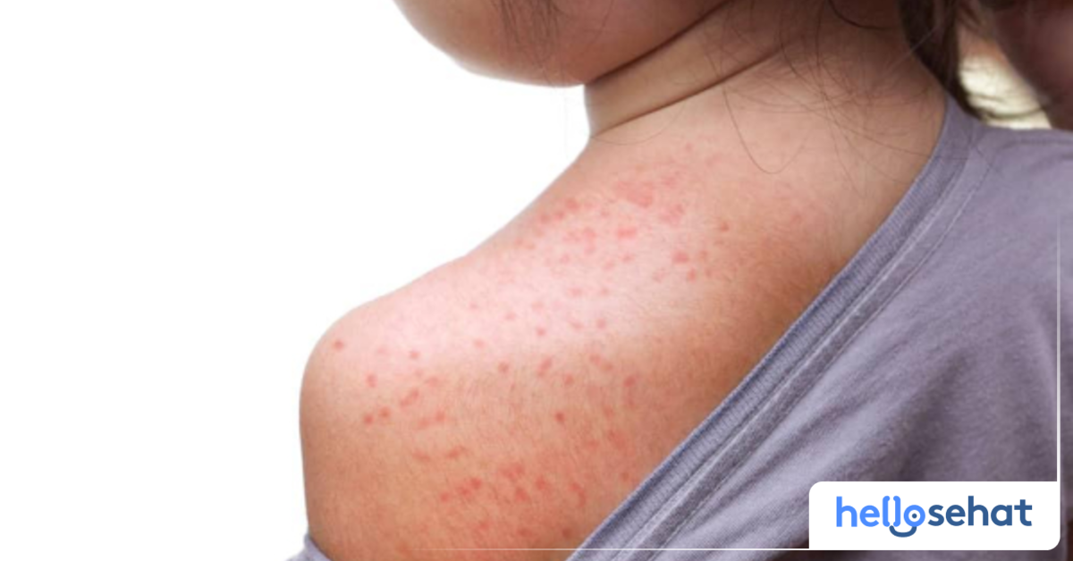 Penyebab Petechiae, Apa Saja yang Perlu Diperhatikan?