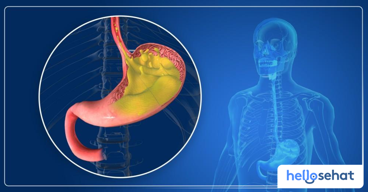 GERD: Gejala, Penyebab, Pengobatan - Hello Sehat