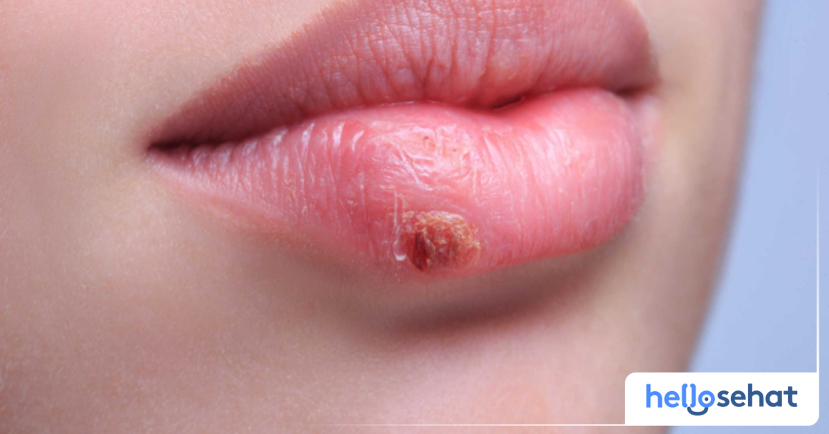 10 Penyebab Bibir Kering yang Jarang Disadari - Hello Sehat