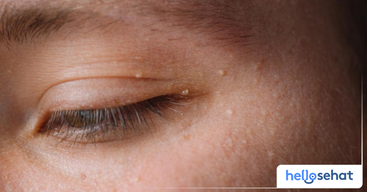 7 Cara Efektif Menghilangkan Milia di Wajah - Hello Sehat