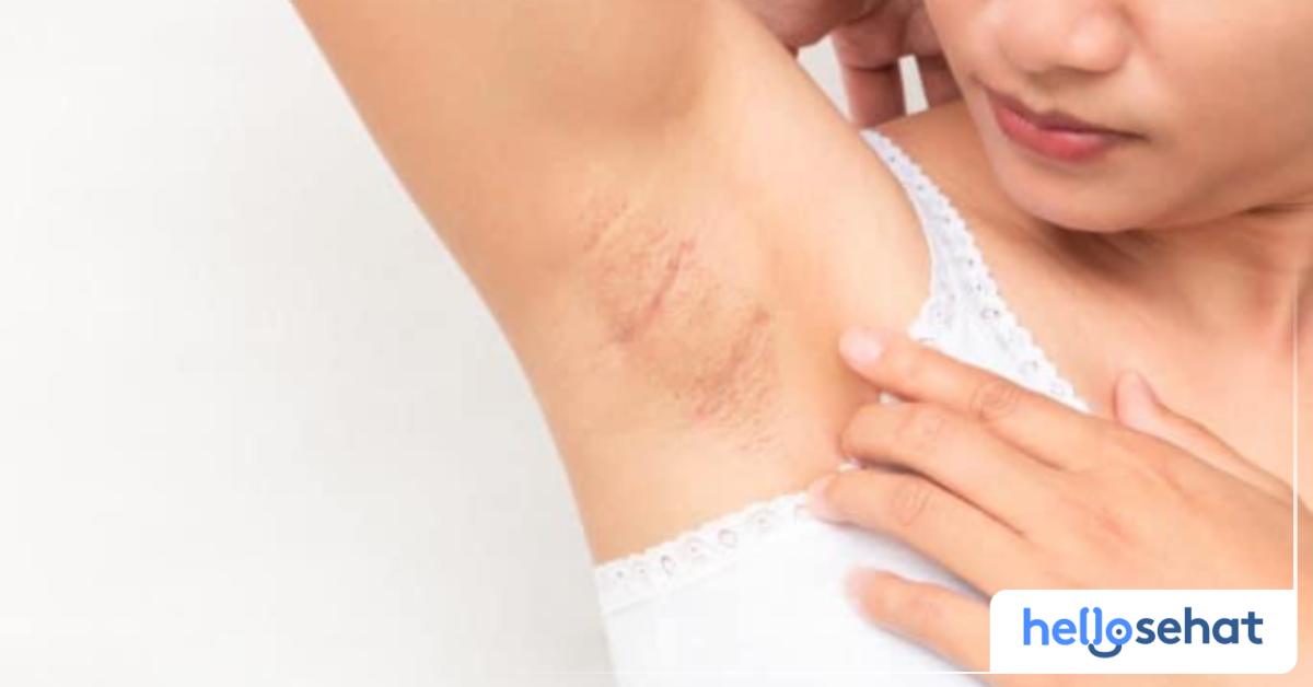 9 Penyebab Ketiak Hitam, Mana yang Anda Alami? - Hello Sehat