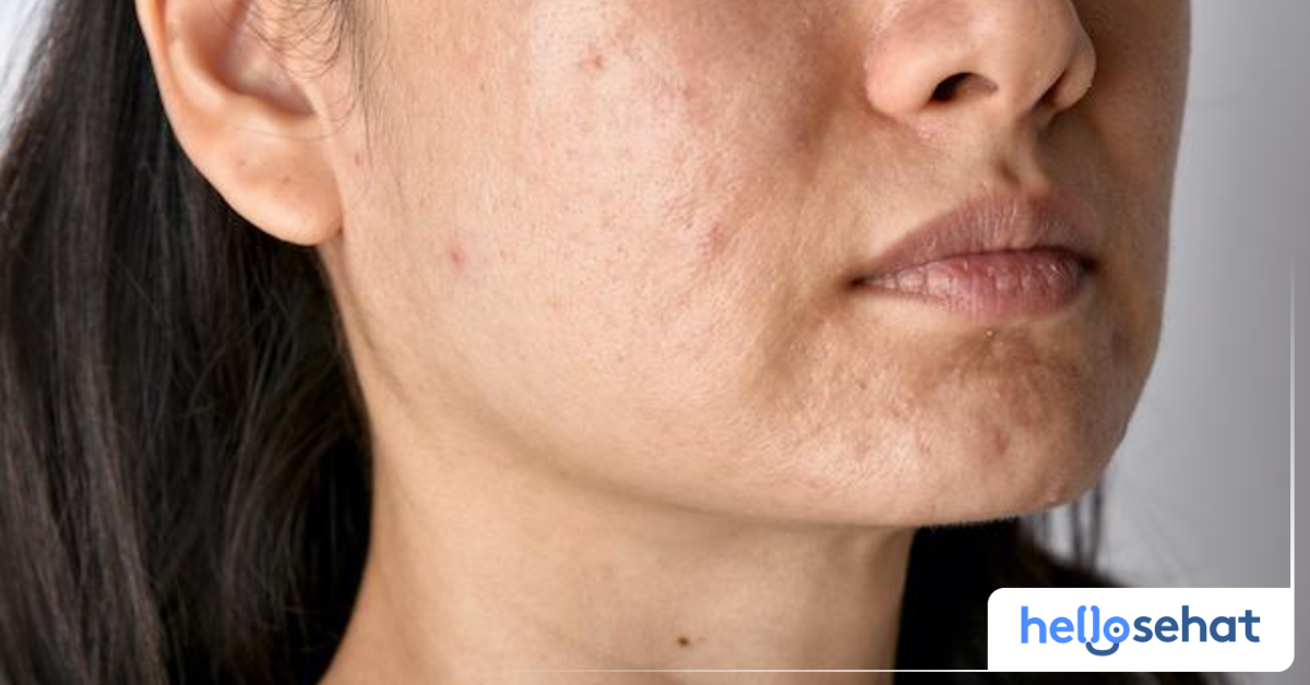Penyebab dan Cara Menghilangkan Bruntusan - Hello Sehat