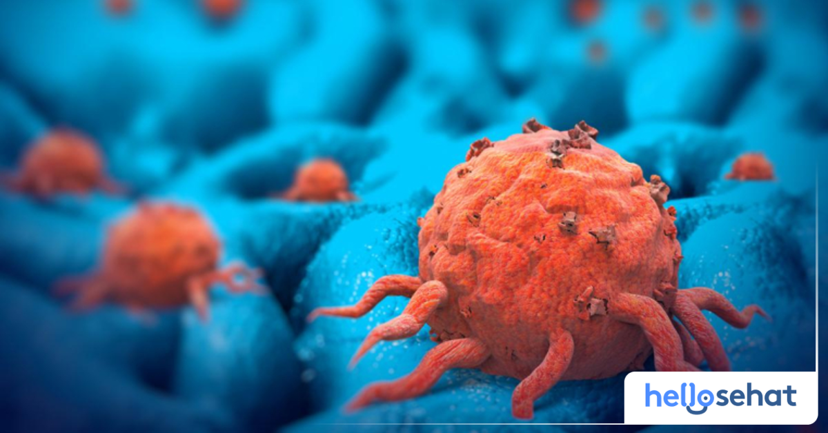 Tumor: Gejala, Penyebab, Pengobatan, dll. - Hello Sehat