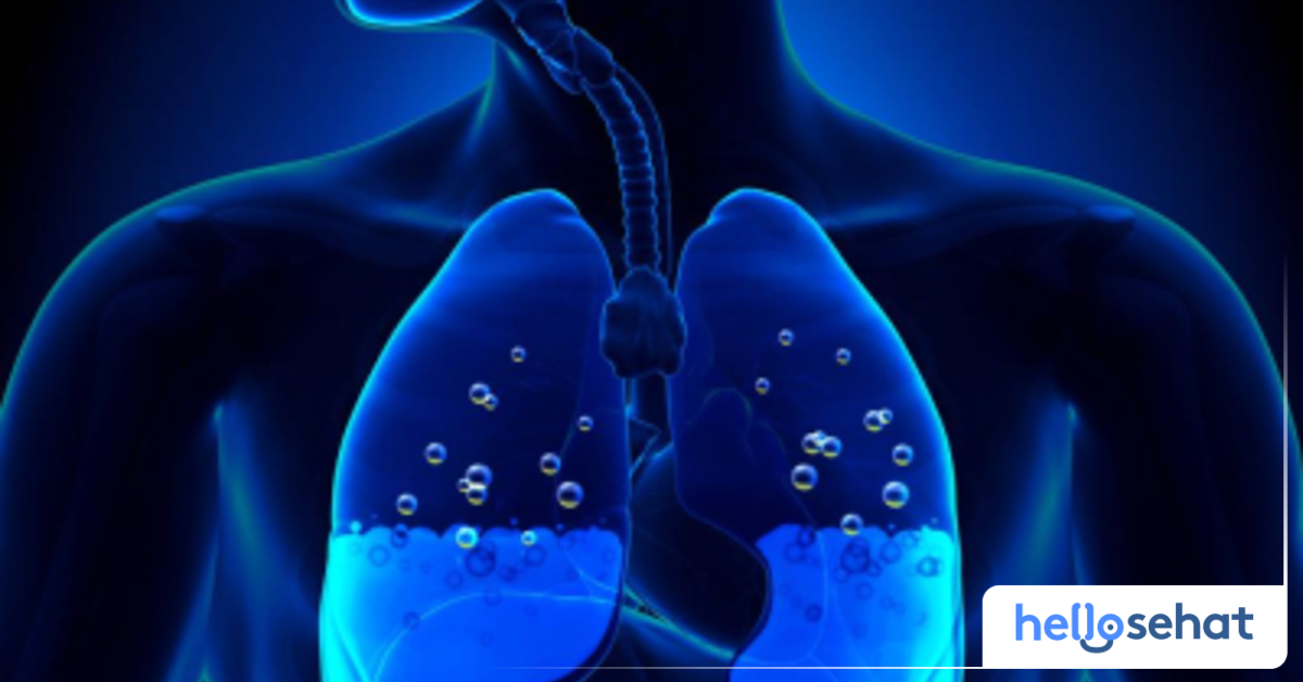 Edema Paru: Gejala, Penyebab, Pengobatan, dll. - Hello Sehat