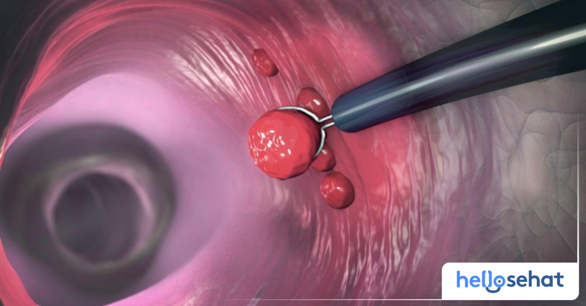 Polip: Gejala, Penyebab, Pengobatan, dll - Hello Sehat