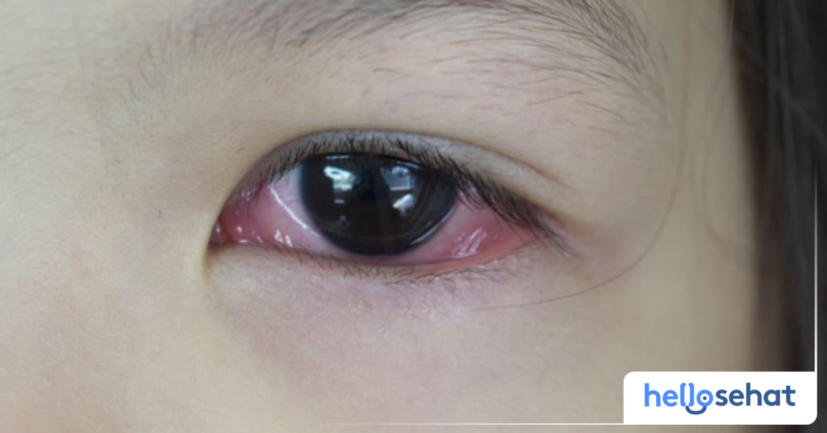 Mata Merah Setelah Menangis, Ini Dia Penyebabnya