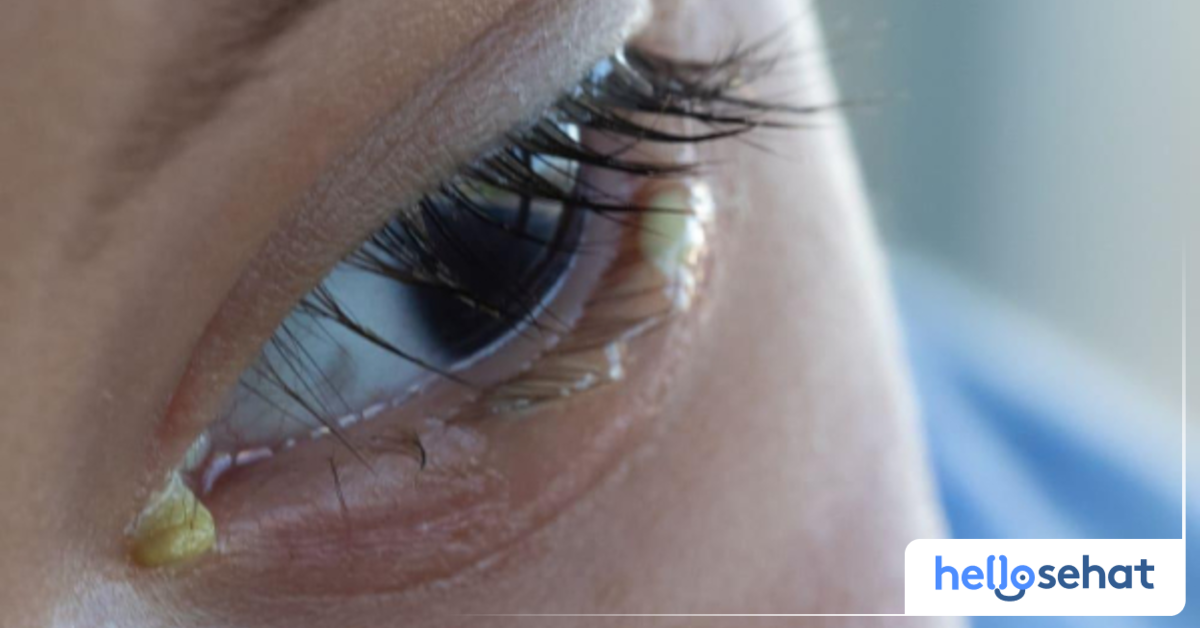 Penyebab Mata Belekan dan Cara Mengatasinya - Hello Sehat