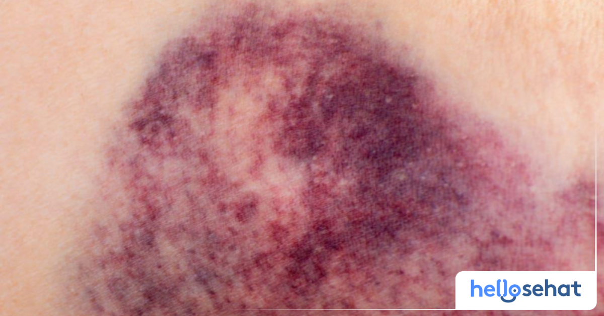 Penjelasan Tentang Munculnya Lebam Pada Tubuh Orang yang Meninggal