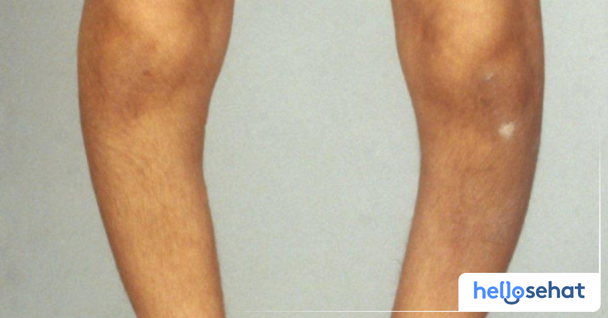 Rakitis: Gejala, Penyebab, dan Cara Mengobati - Hello Sehat