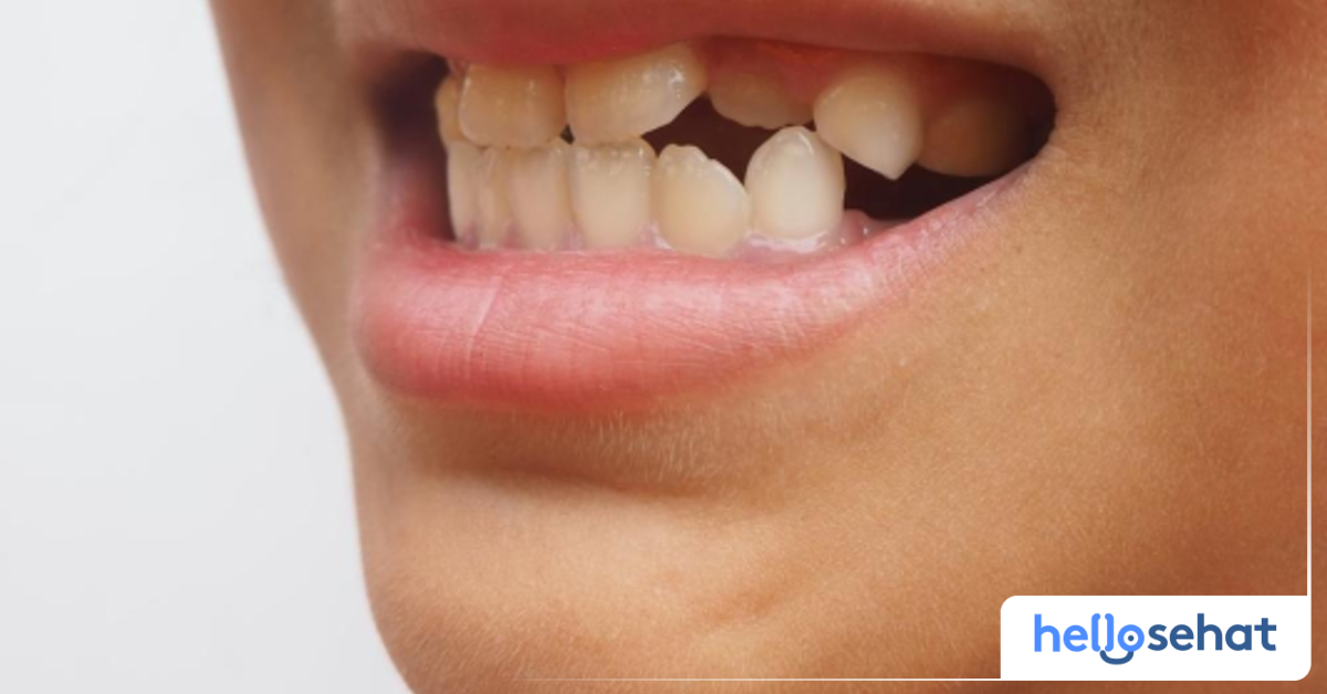 Hyperdontia: Gejala, Penyebab, Pengobatan - Hello Sehat