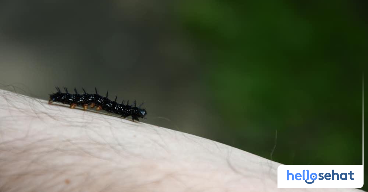 6 Cara Mengatasi Gatal karena Ulat Bulu yang Tepat
