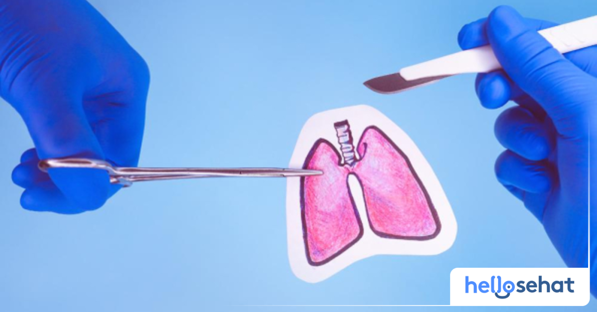 Bullectomy (Bulektomi): Fungsi, Prosedur, dan Risiko | Hello Sehat