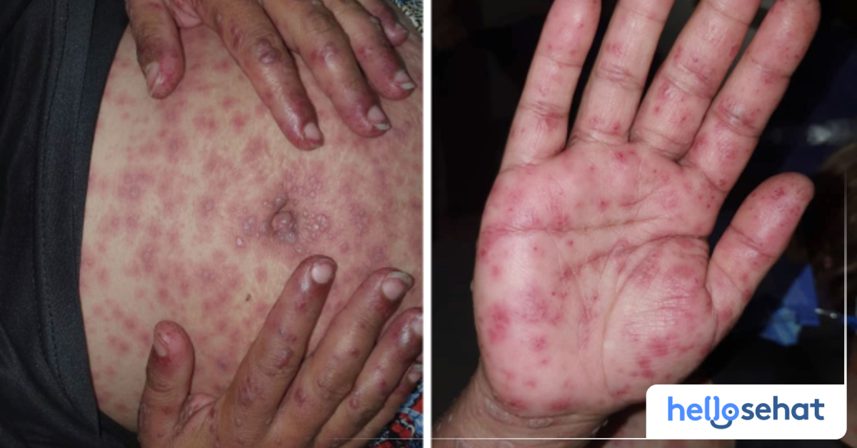 Pengalaman Saya Melewati Masa Kritis Steven Johnson Syndrome • Hello Sehat