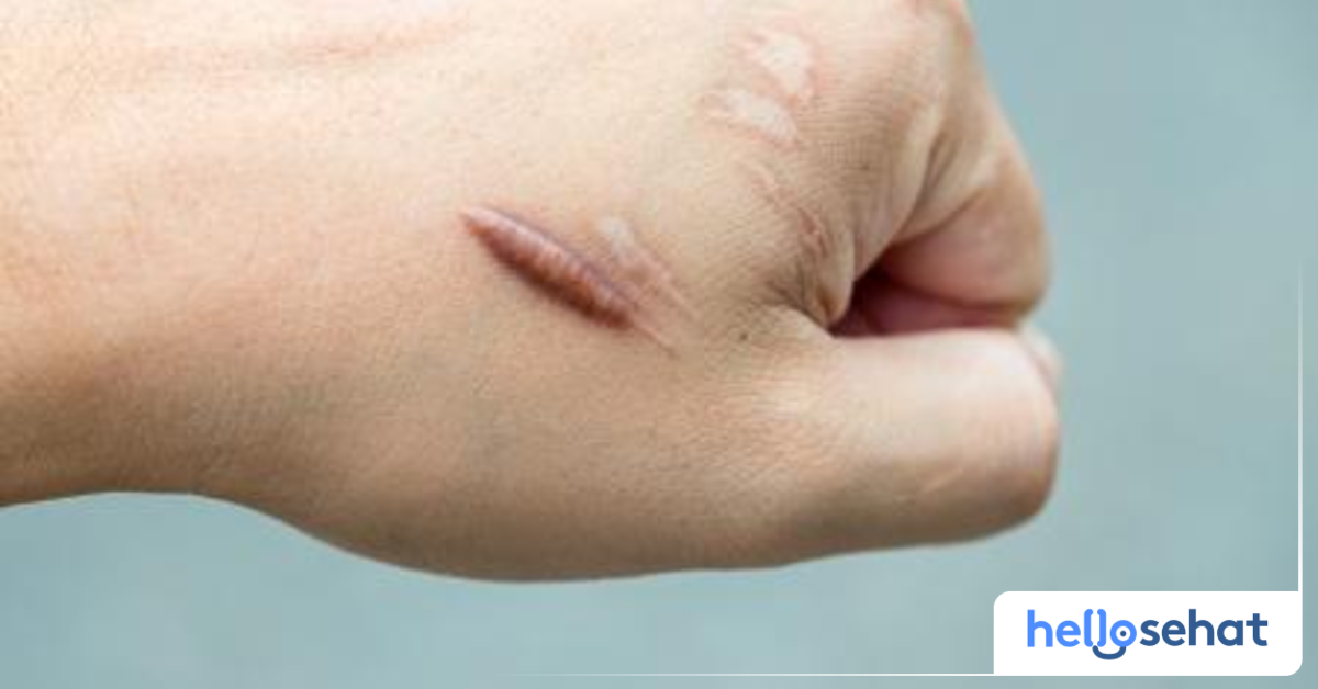 5 Jaringan Parut pada Kulit dan Cara Mengatasinya - Hello Sehat