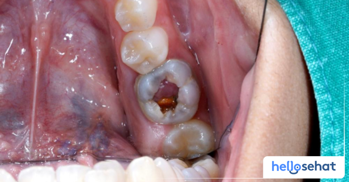 Polip Pulpa: Obat, Penyebab, Gejala, dll. - Hello Sehat