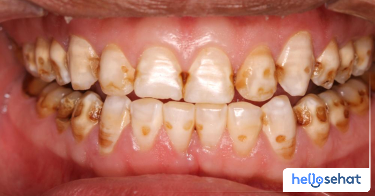 Atrisi Gigi: Gejala, Penyebab, Pengobatan - Hello Sehat