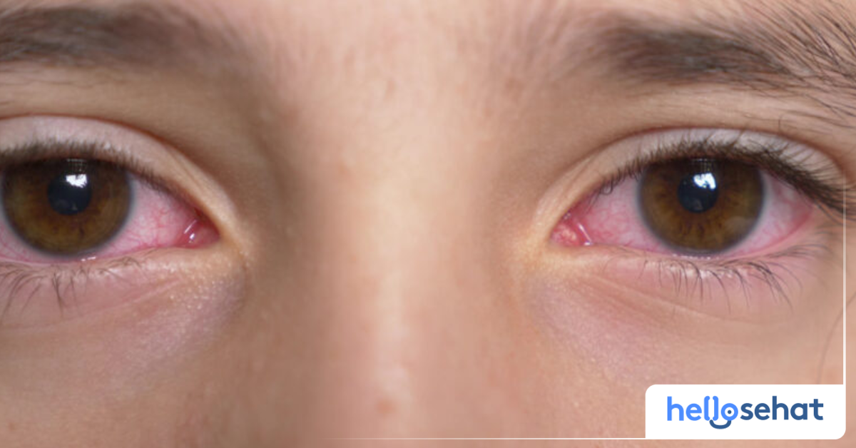 Mata Merah pada Anak: Penyebab dan Pengobatannya