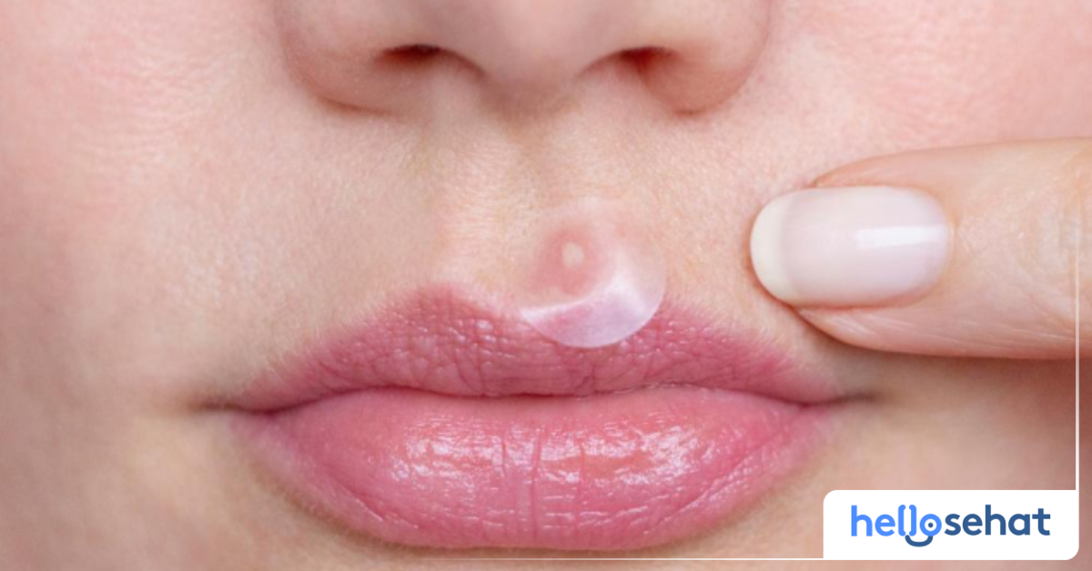 10 Acne Patch Terbaik untuk Kempeskan Jerawat dengan Cepat