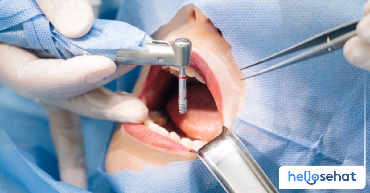 Kuretase Gigi: Definisi, Tujuan, Prosedur, dll. - Hello Sehat