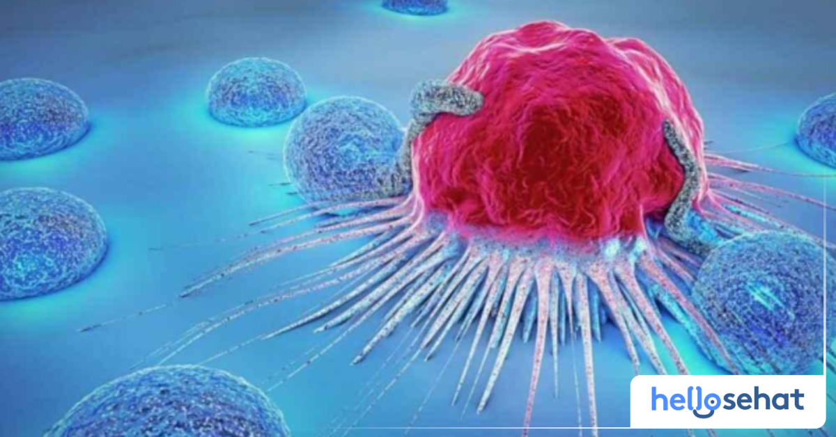 Mengenal 3 Jenis Tumor Berdasarkan Sifatnya - Hello Sehat