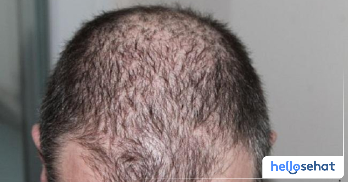 9 Penyebab Rambut Botak di Usia Muda dan Pengobatannya